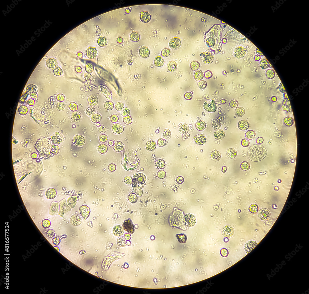 Pus cells (WBC), Red blood cells (RBC) and occasionally epithelial ...