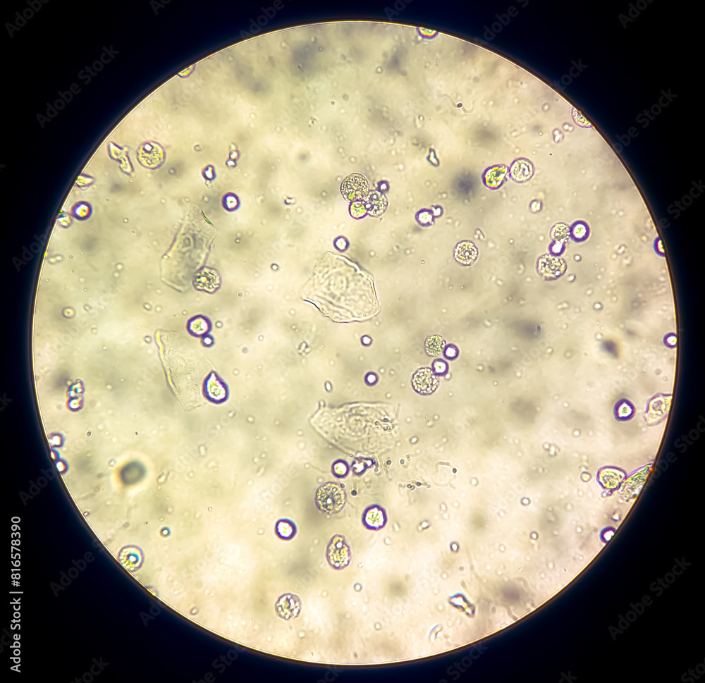 Pus cells (WBC), Red blood cells (RBC) and occasionally epithelial ...