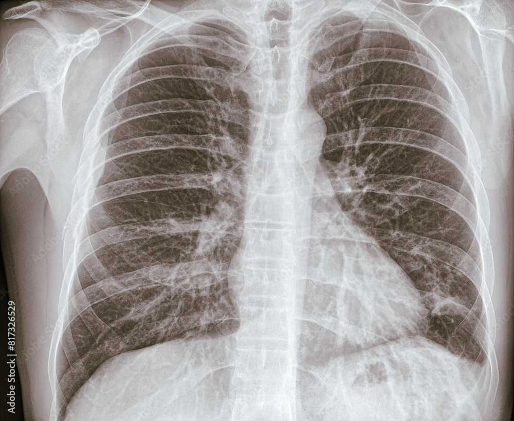 Foto de Stock X ray radiograph right shoulder with many broken ribs and ...