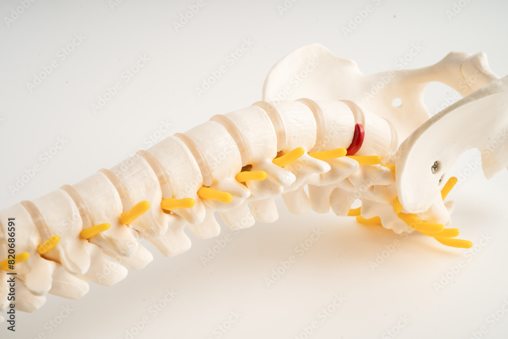 Foto Lumbar spine displaced herniated disc fragment, spinal nerve and ...
