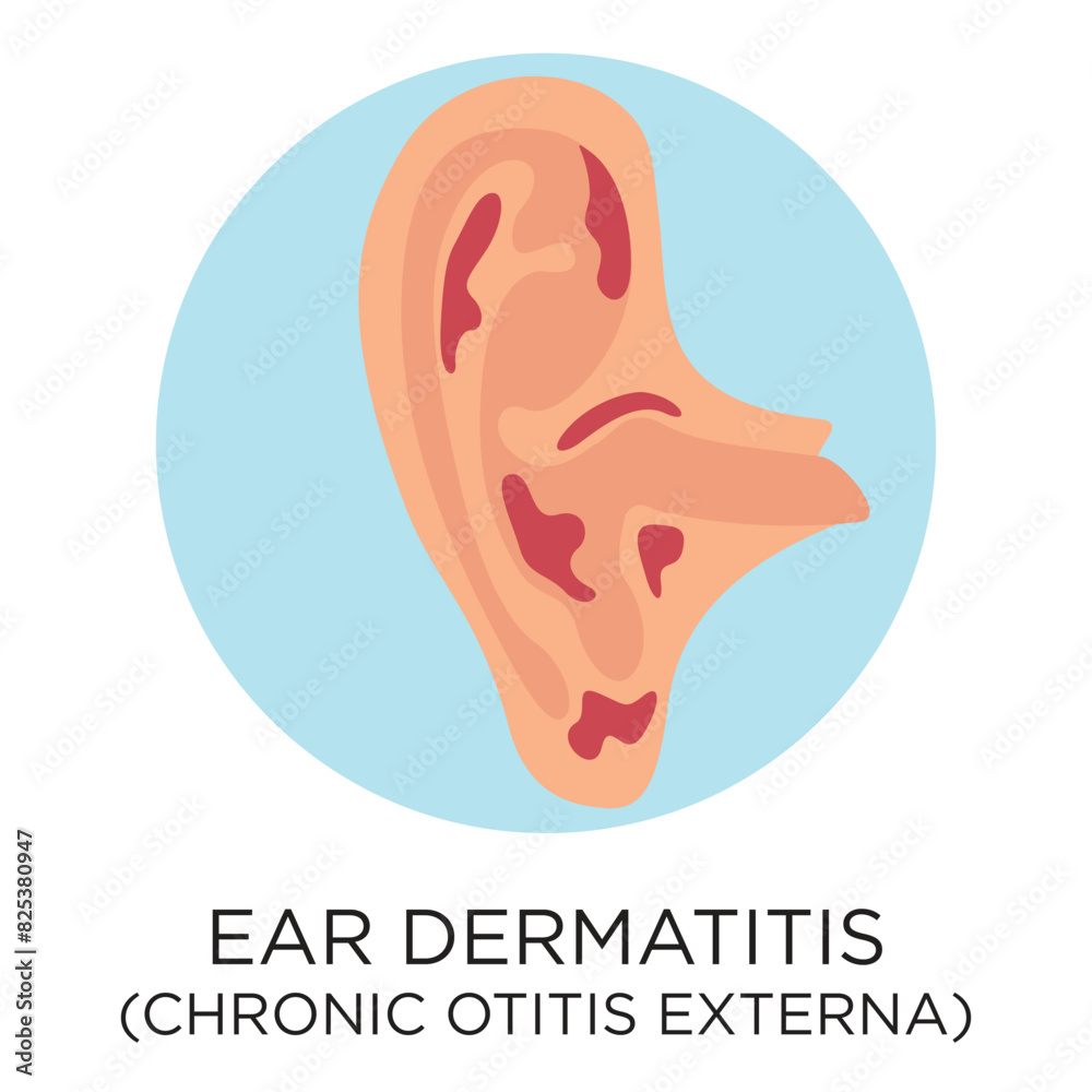 Ear dermatitis (chronic otitis externa) flat style vector illustration ...