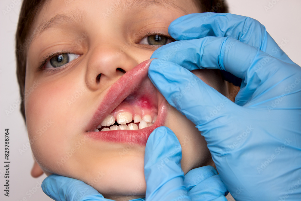 A dentist wearing medical gloves examines a child's oral cavity, close ...