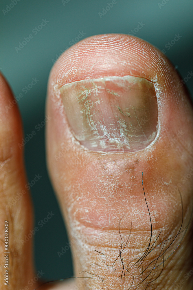 Top view of the foot and Brittle toenail causing nail surface layers or ...