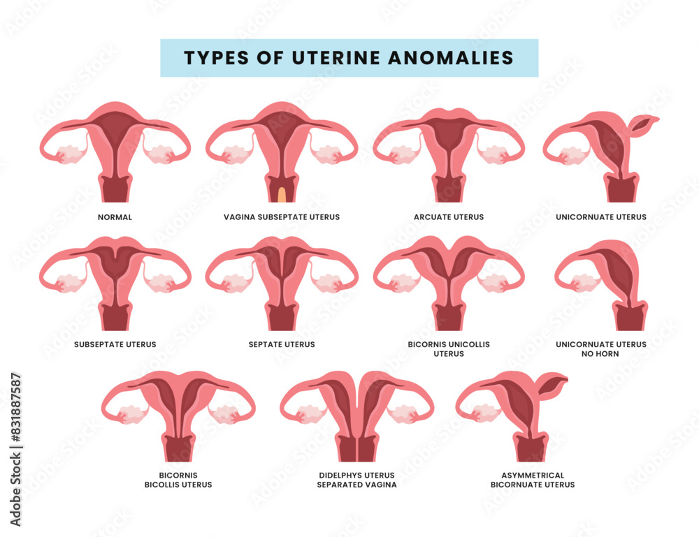 Set of Congenital anomalies of the female genital tract collection ...