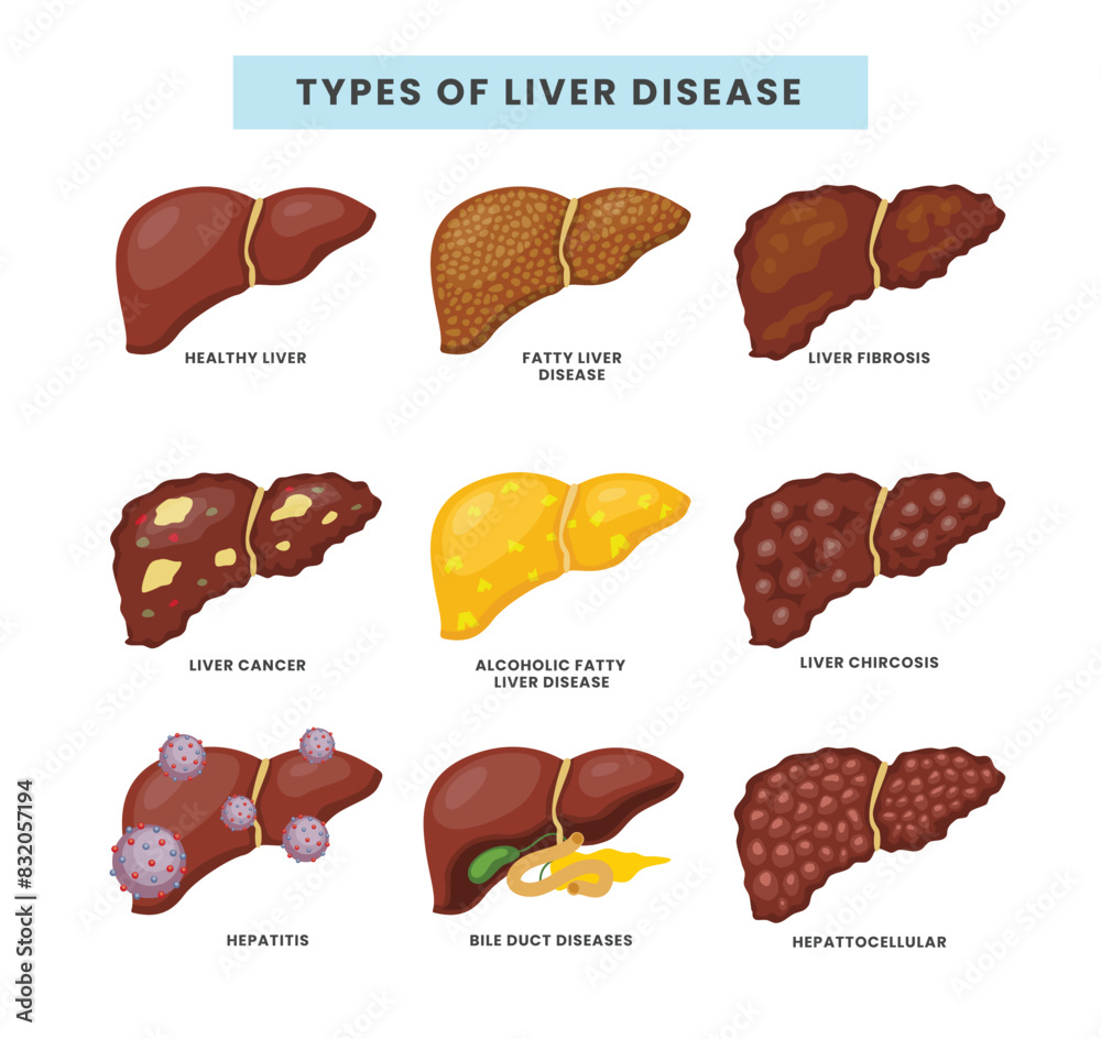 Set of different types of liver disease collection with fatty liver ...