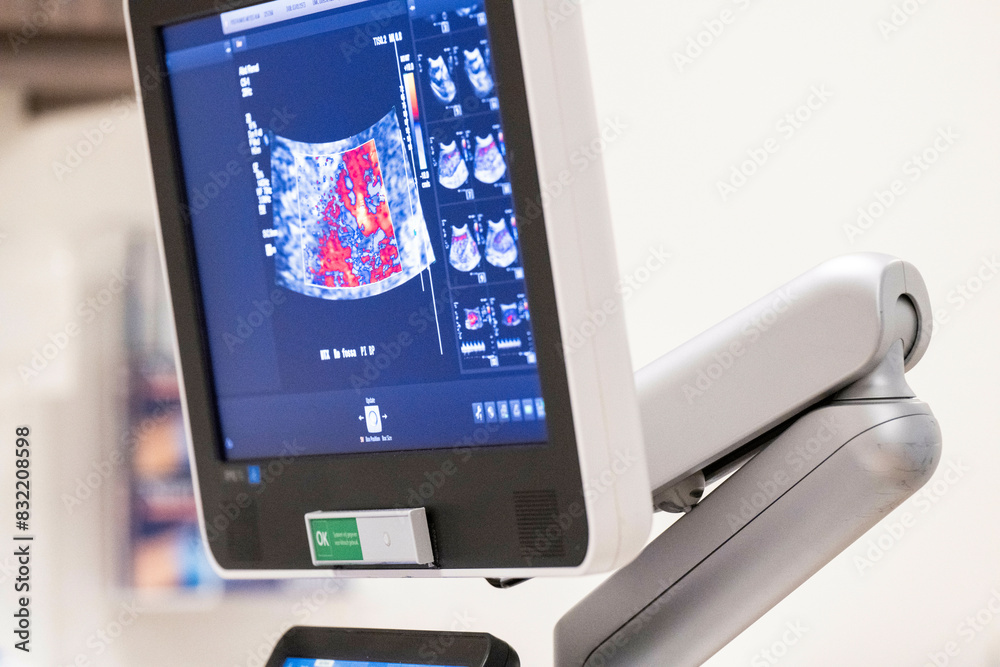 An ultrasound machine's monitor displays a colorful Doppler image ...