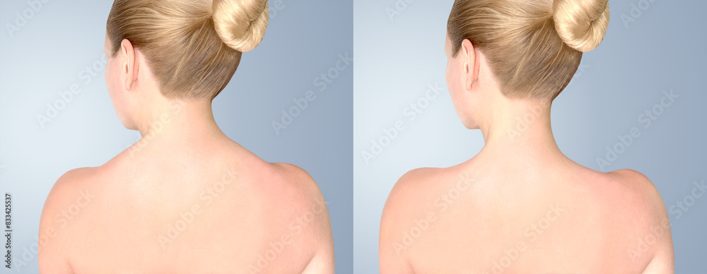 Botulinum toxin injection for trapezius muscle. Back of neck and ...