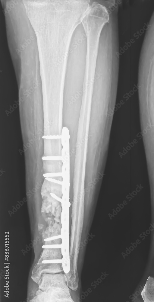 X-ray of the leg. Old spiral fracture at left lower tibia. Evidence of ...
