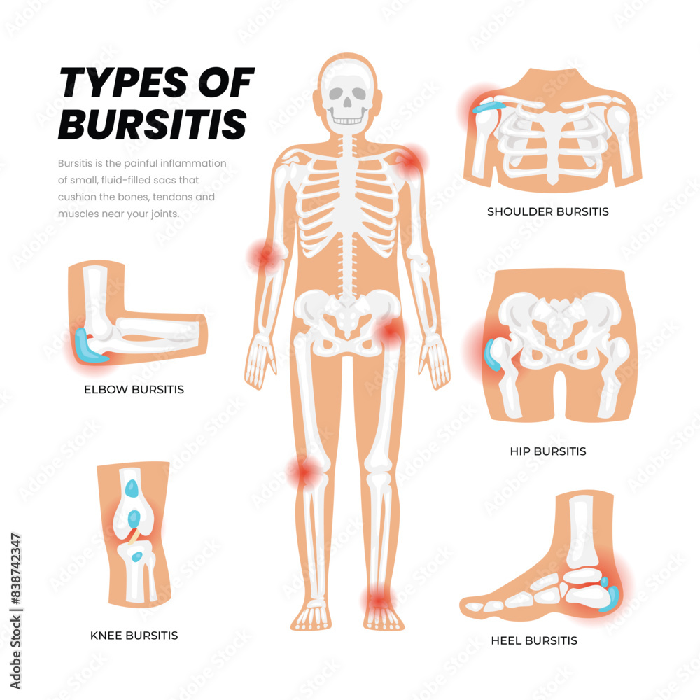 Different types of bursitis as medical body joints inflammation list ...