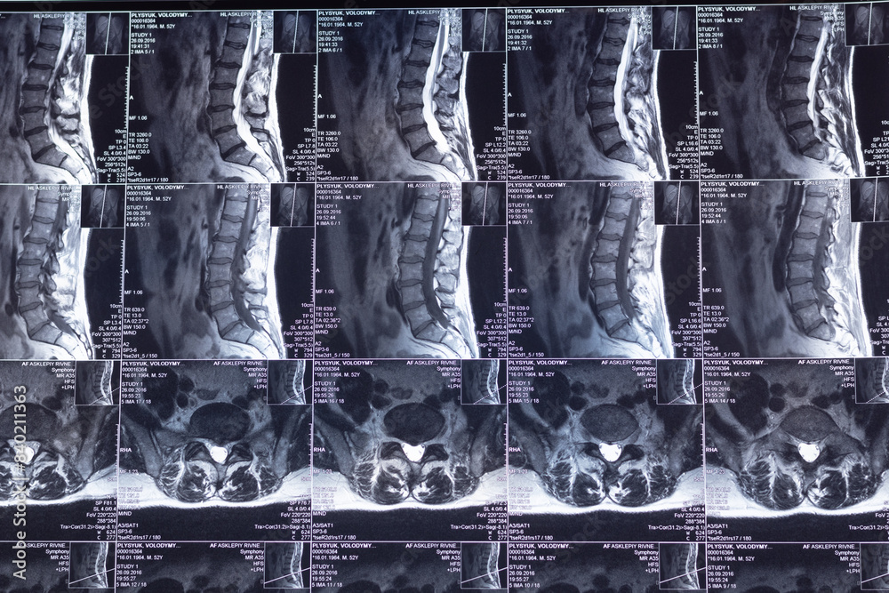 Stock-Foto „X-ray and MRI, MRT, CT with the human spine with defects in ...