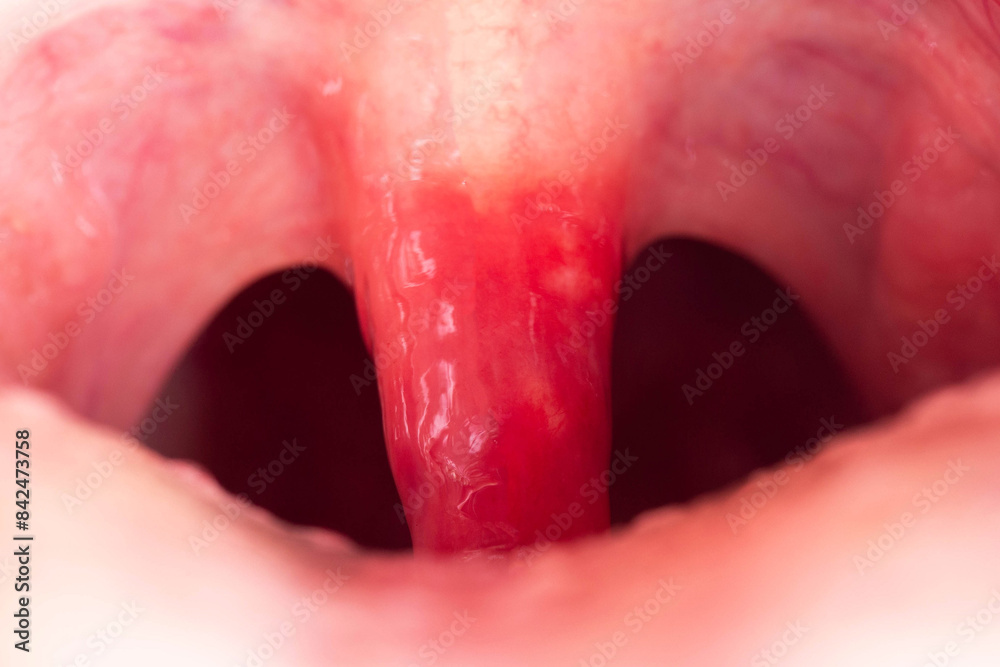 Long uvula with inflammation of infections and viruses. Treatment of ...