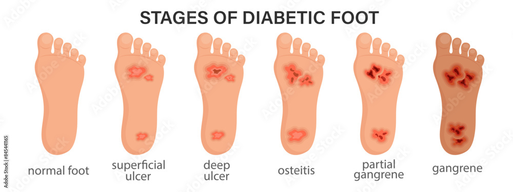 Stages of diabetic foot syndrome. Deep ulcer, open wound on the foot ...