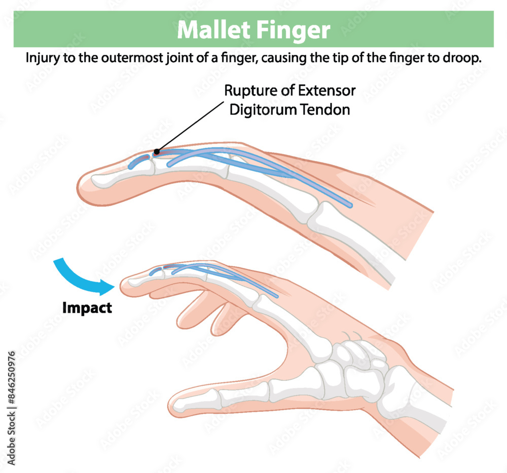 Diagram showing mallet finger injury and tendon rupture Stock Vector ...
