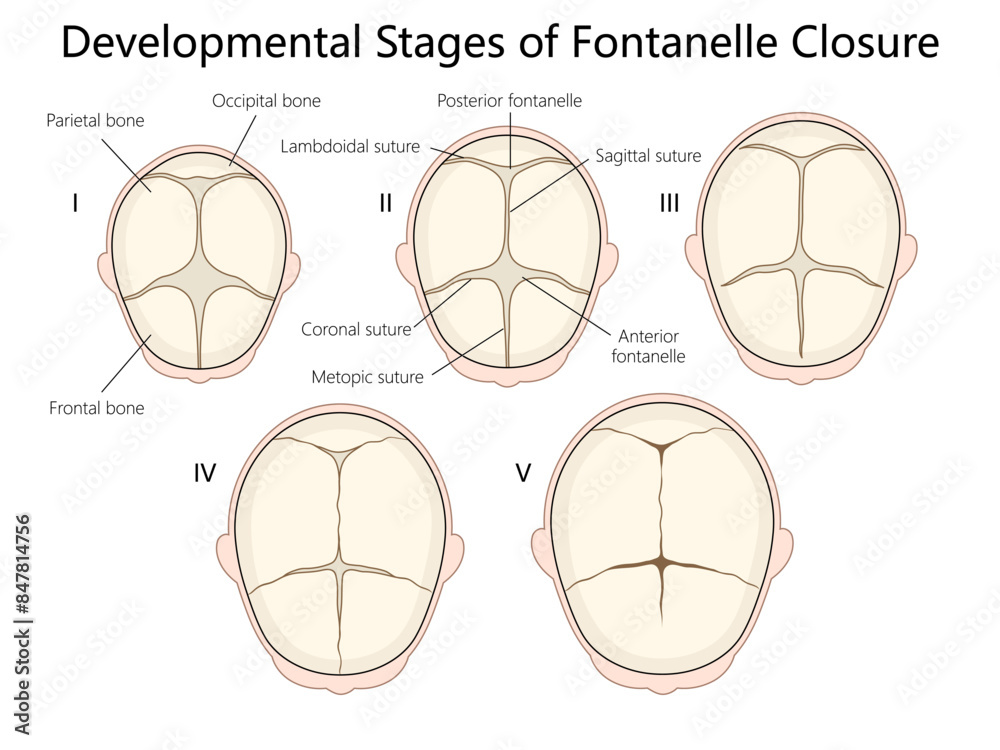 developmental stages of fontanelle closure in infants, detailing ...