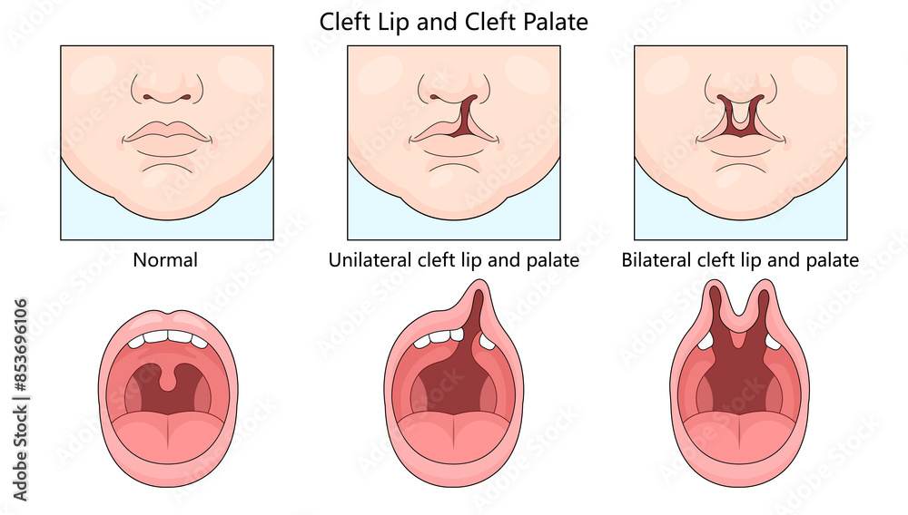 Ilustrace normal, unilateral cleft lip and palate, and bilateral cleft ...