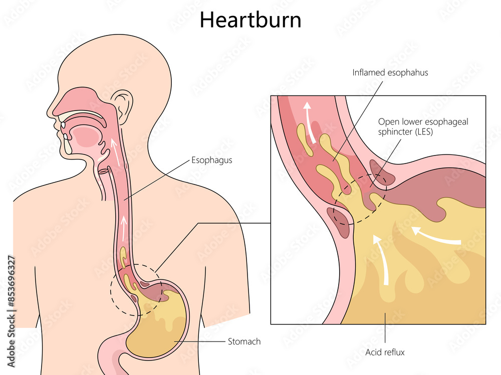 anatomy of heartburn and acid reflux, with labeled parts of the esophagus and stomach diagram ...