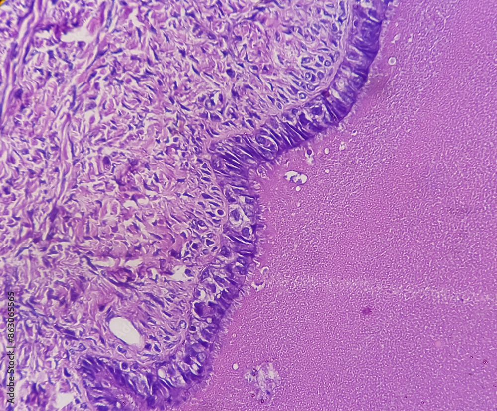 Microscopic image of Papillary borderline serous tumor of the ovary (low malignant potential ...