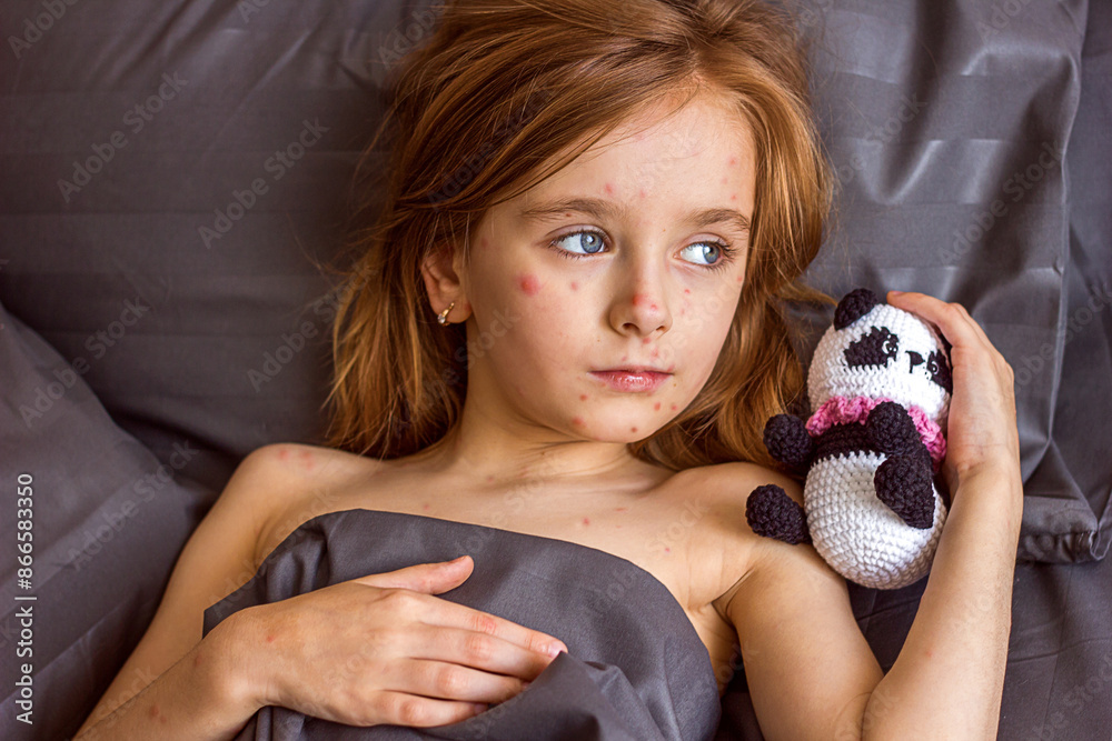 Little sad girl with a rash on her face and body lies in bed with a toy ...