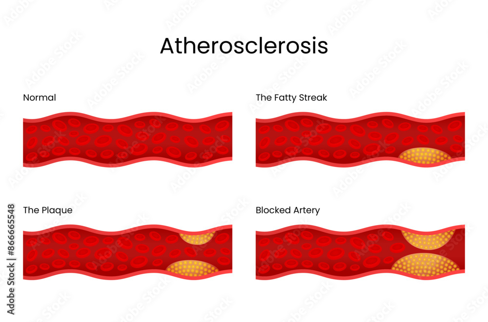 Stages of Atheroscleorosis. Normal Artery, The Fatty Streak, The Plaque ...