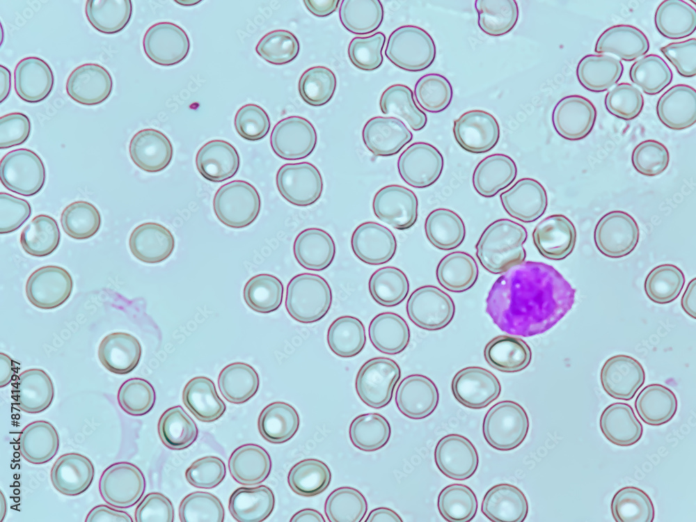 Photomicrograph showing Aplastic anemia, a rare but serious blood ...