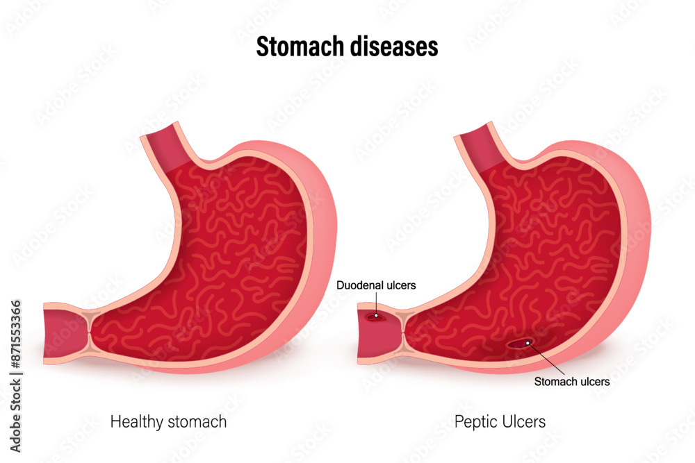 Stomach diseases. Comparison of healthy stomach and peptic ulcers ...