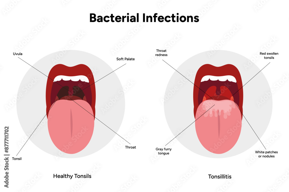 Viral bacterial infection, sore throat, tonsillitis, and healthy ...