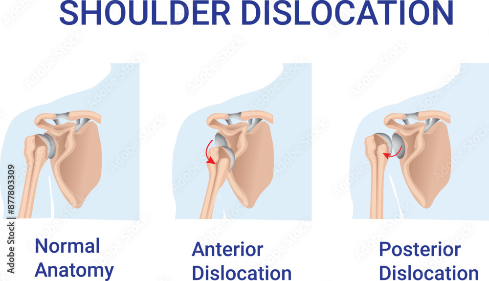 Shoulder Dislocation, normal anatomy, anterior Dislocation and posterior dislocation ...