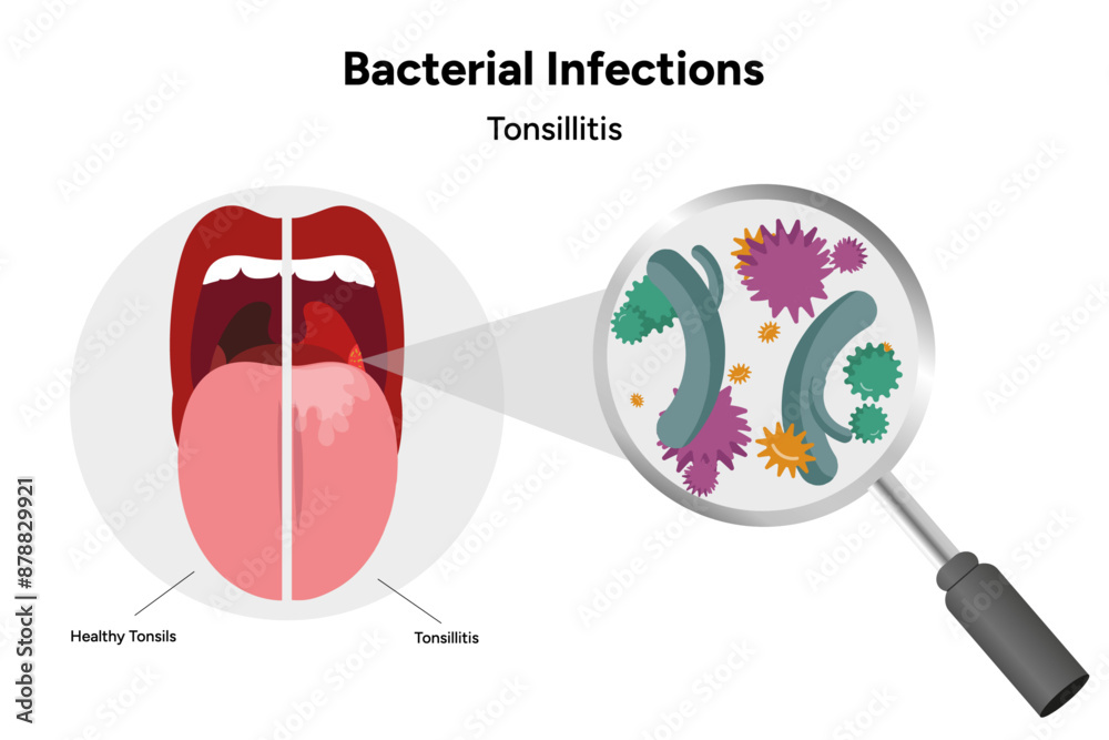 Bacterial infection tonsillitis Stock Vector | Adobe Stock