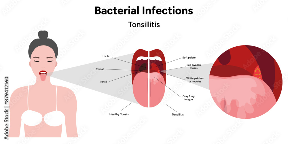 Bacterial infection tonsillitis Stock Vector | Adobe Stock