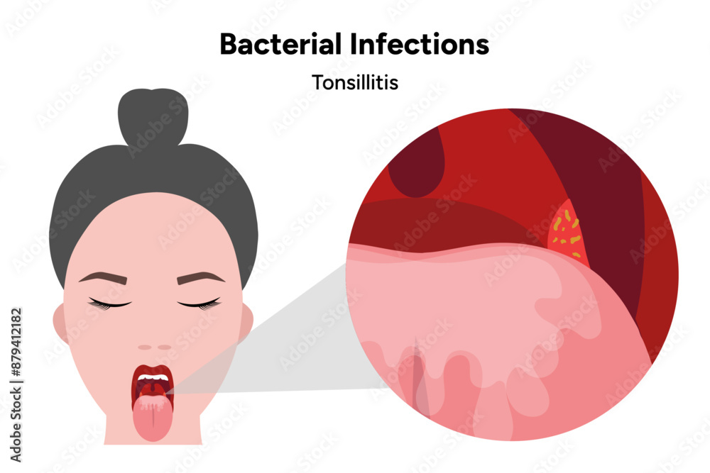 Bacterial infection tonsillitis Stock Vector | Adobe Stock