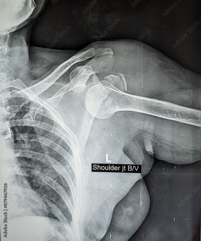 x ray image shows anterior dislocation of shoulder joint Stock Photo ...