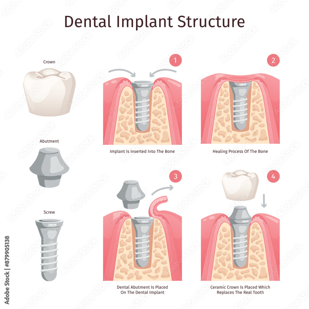Dental implant structure. Tooth implantation procedure teeth ...