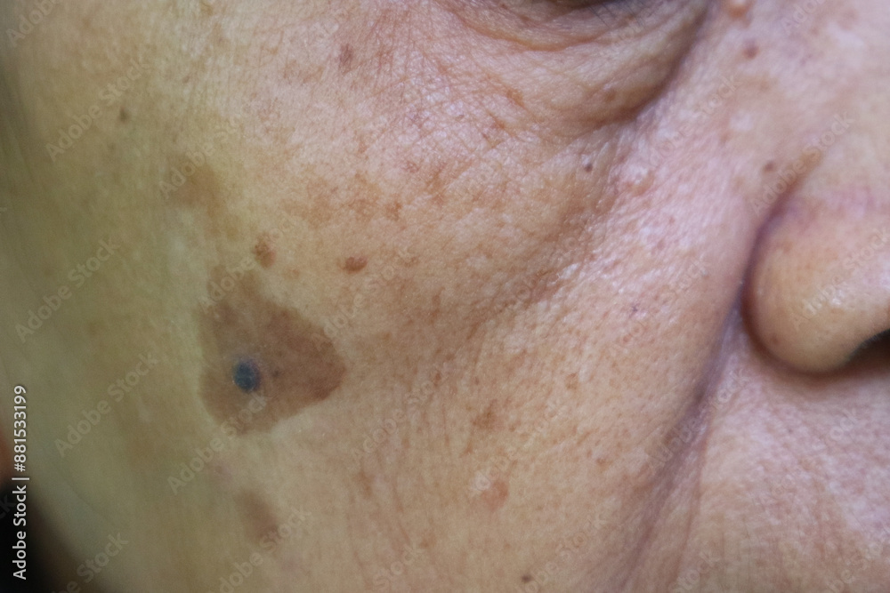 Age spots with lentigo maligna, eye bags and smile line on the old ...