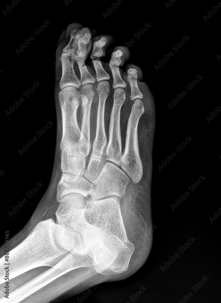x-ray of foot fractured metatarsal bone. roken foot, oblique view, show ...