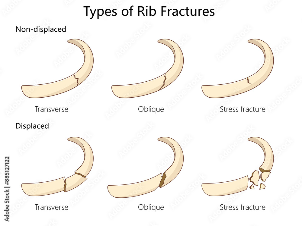 Ilustración de Stock types of rib fractures, non-displaced and ...
