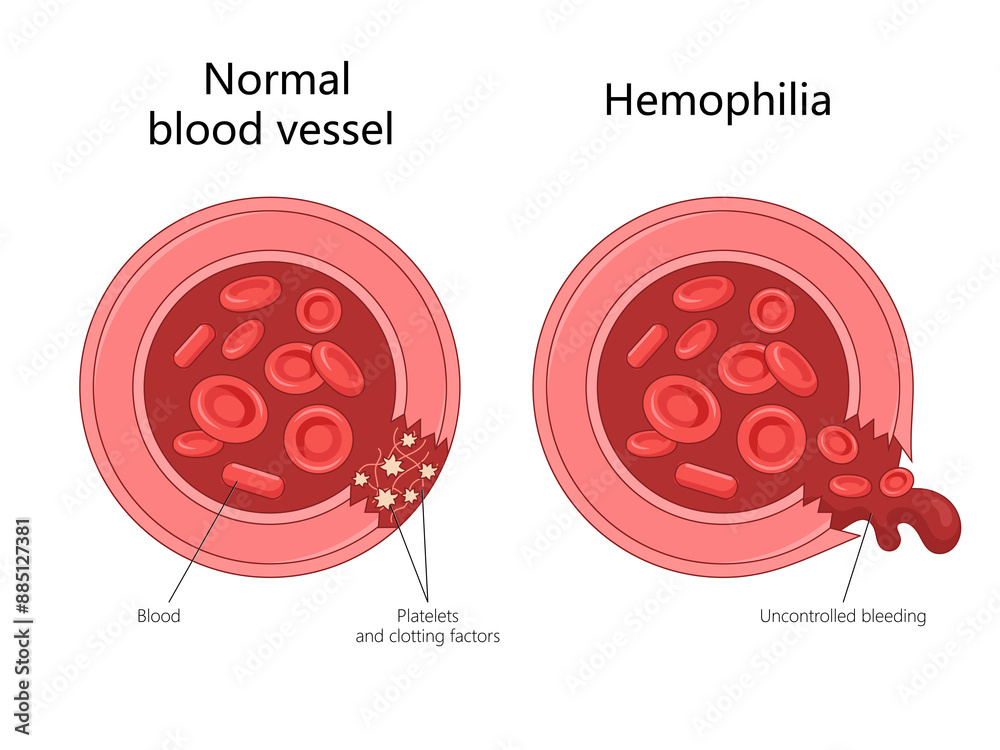 comparing a normal blood vessel with one affected by hemophilia ...
