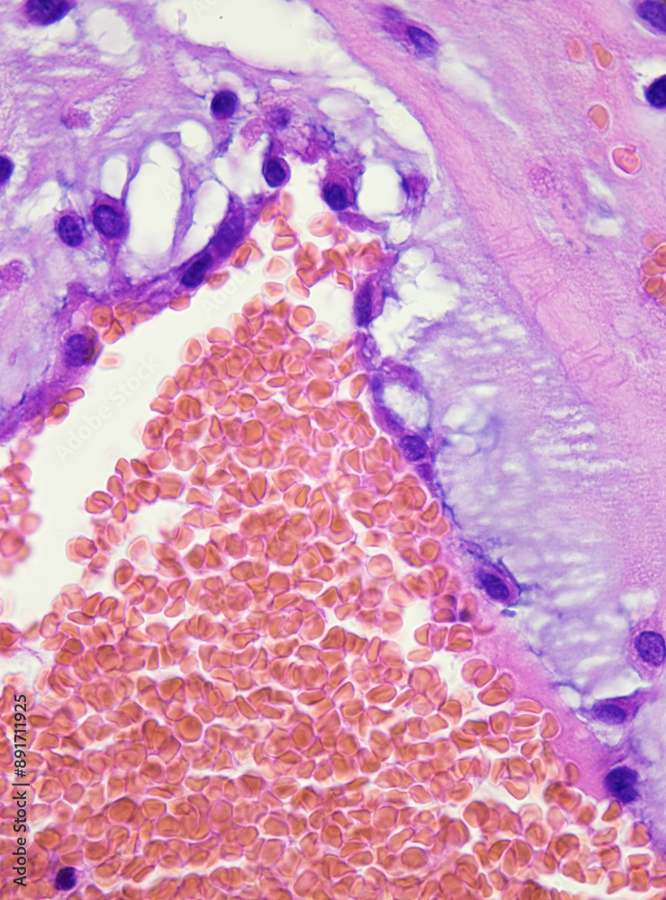This photo shows the pink mucinous matrix of atrial myxoma, myxoma ...