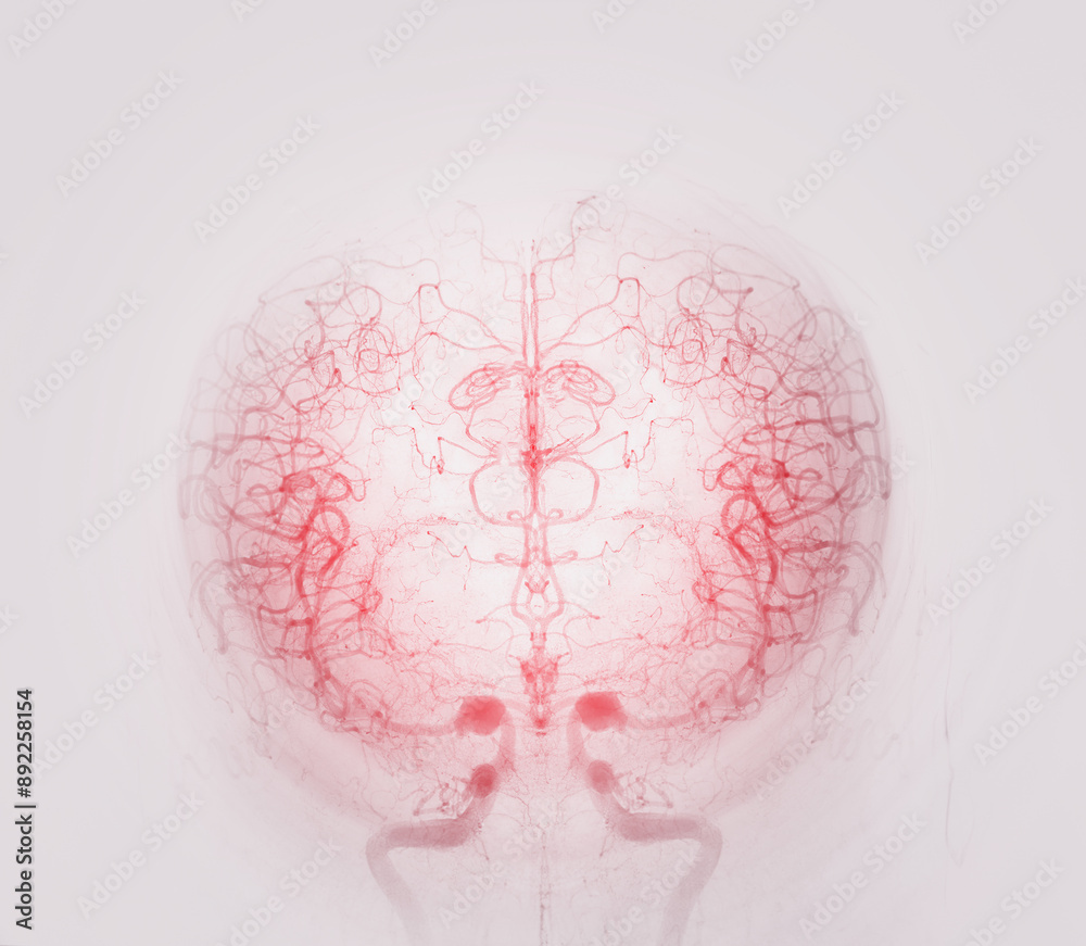 Cerebral angiography is a specialized procedure to visualize the ...