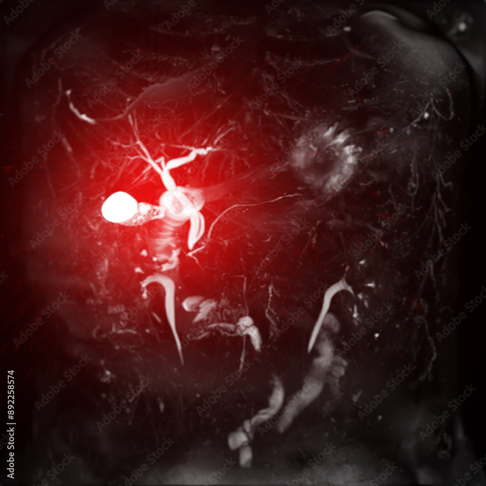 Magnetic resonance cholangiopancreatography or MRCP showing Gallbladder ...