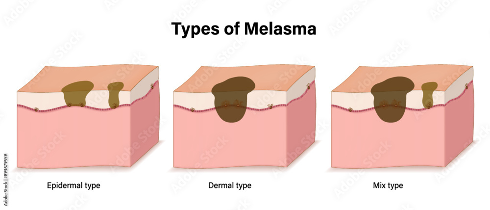 Types of melasma vector. Epidermal, Dermal and mix type. Facial skin ...