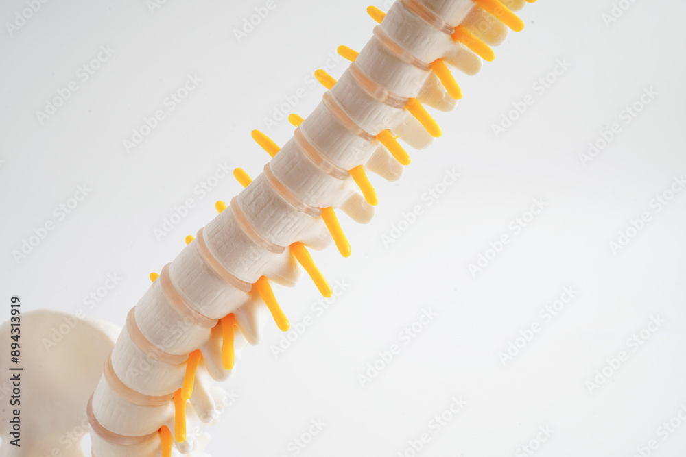 Spinal nerve and bone, Lumbar spine displaced herniated disc fragment ...