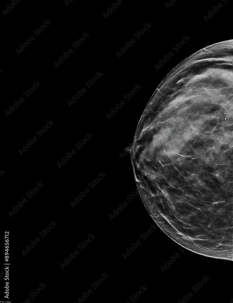 Mammogram. Right bilateral craniocaudal (CC) view (with tomosynthesis ...