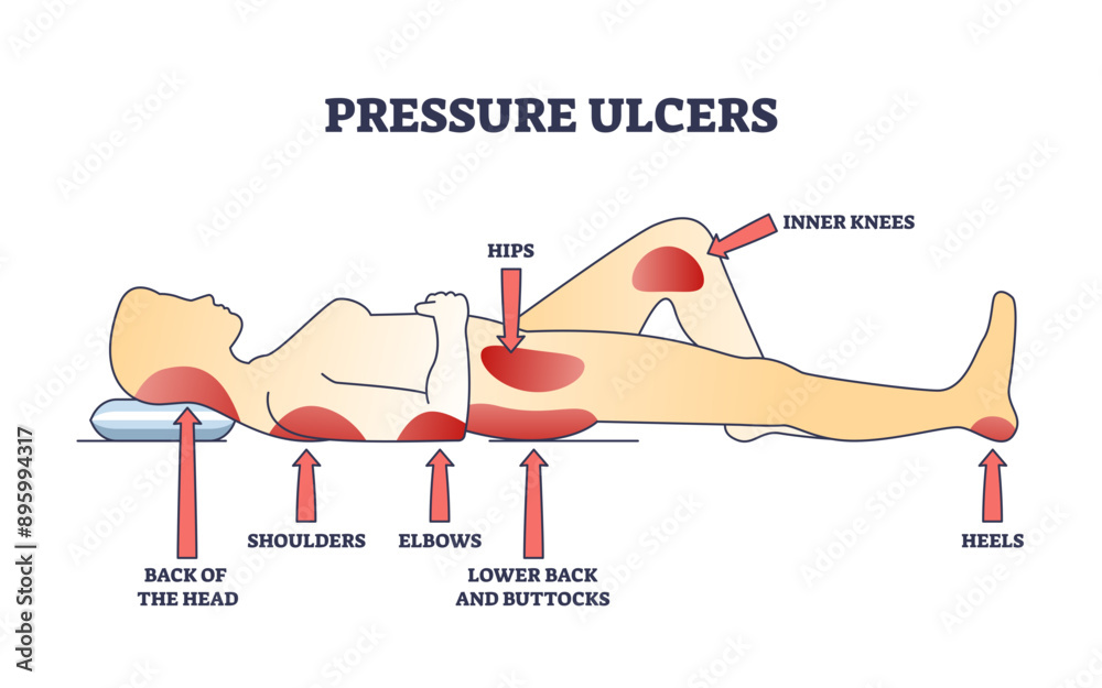 Pressure ulcers or bedsores skin tissue injuries locations outline ...