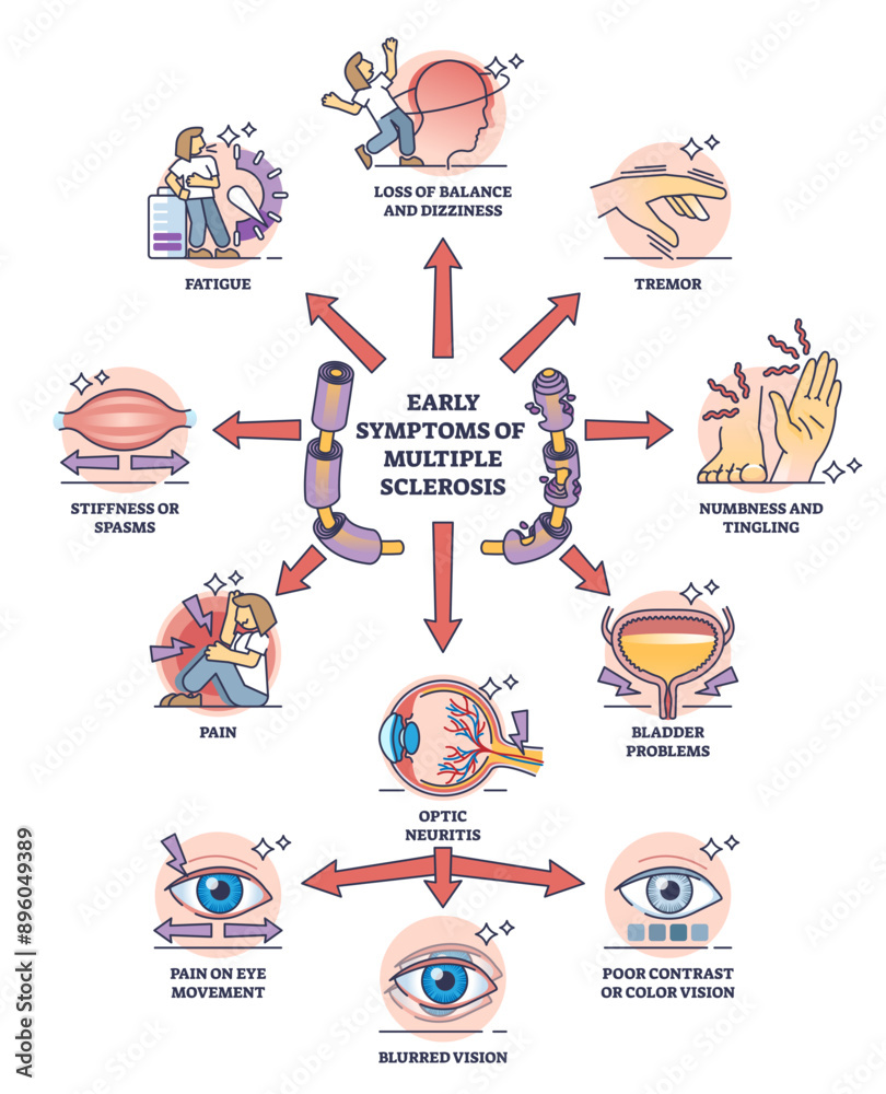 Early symptoms of multiple sclerosis and MS affected things outline ...