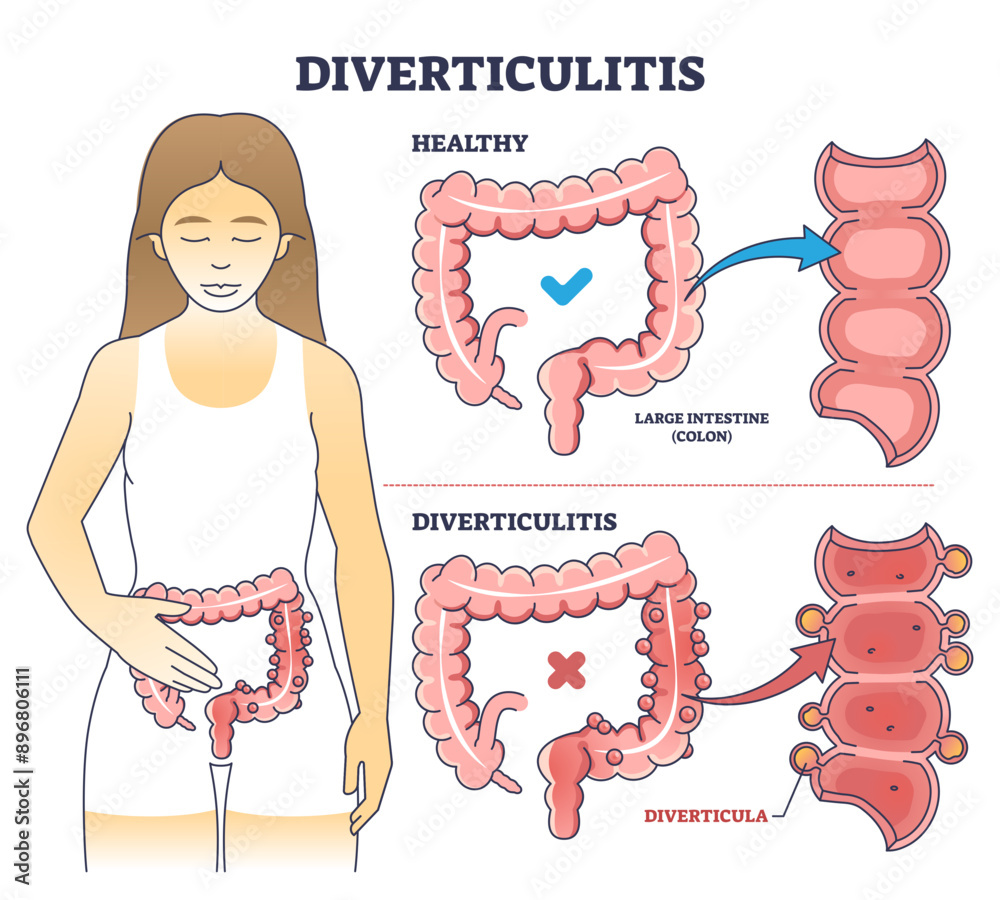 Diverticulitis as digestive conditions for large intestine outline ...