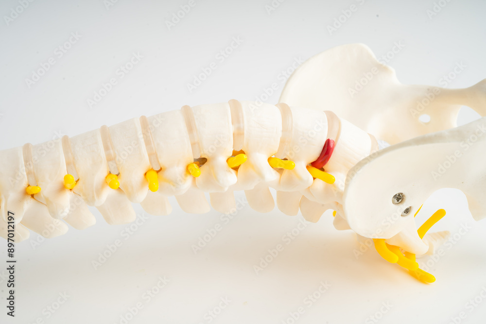 Lumbar spine displaced herniated disc fragment, spinal nerve and bone ...
