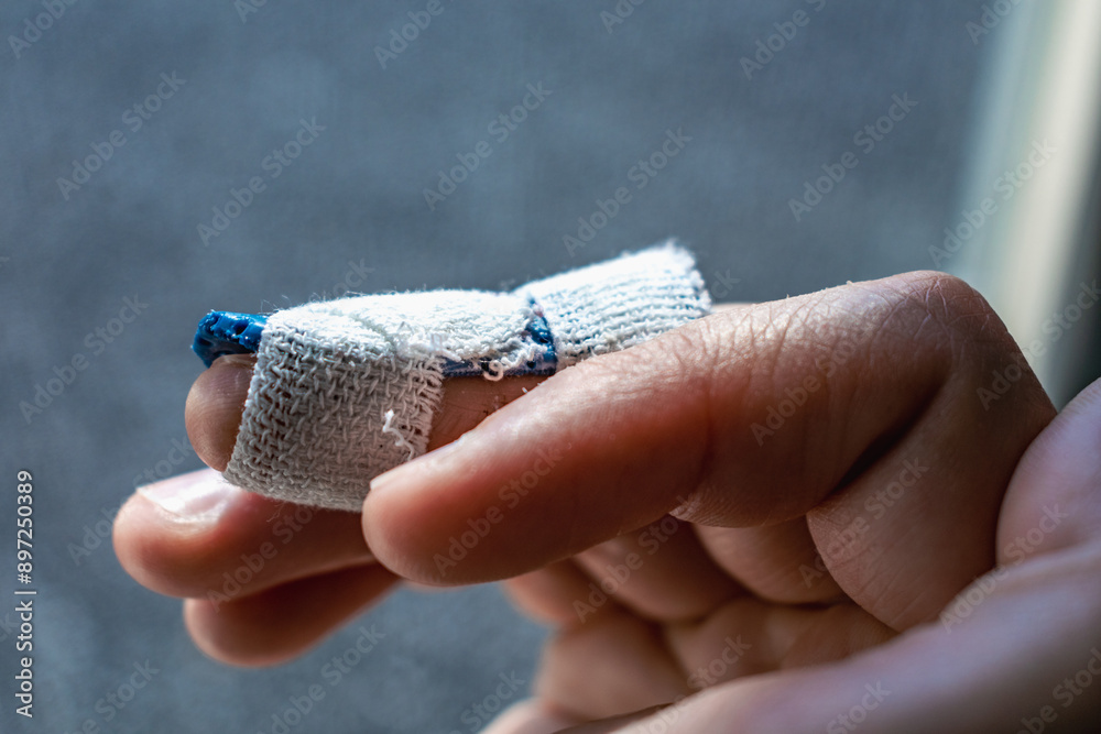 Mallet finger with custom orthosis on the middle finger to immobilize ...