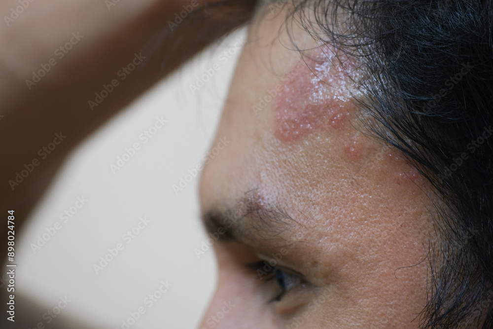 Skin diseases. A man scratching his forehead. Painful forehead skin ...