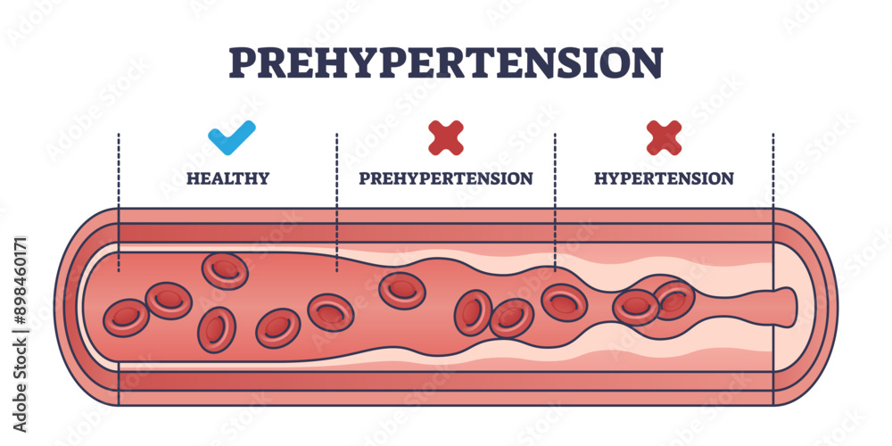 Prehypertension, healthy and hypertension blood flow comparison outline ...
