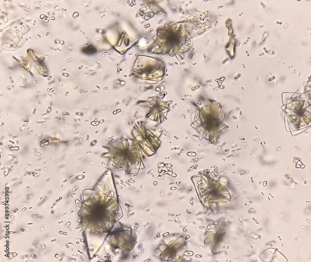 Uric acid crystals and calcium oxalate monohydrate under microscope ...